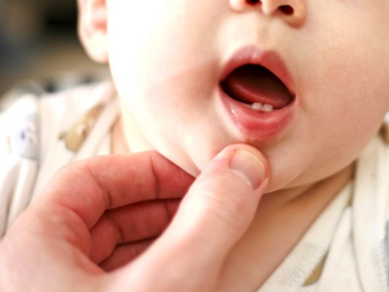 Il mughetto: la candida dei neonati